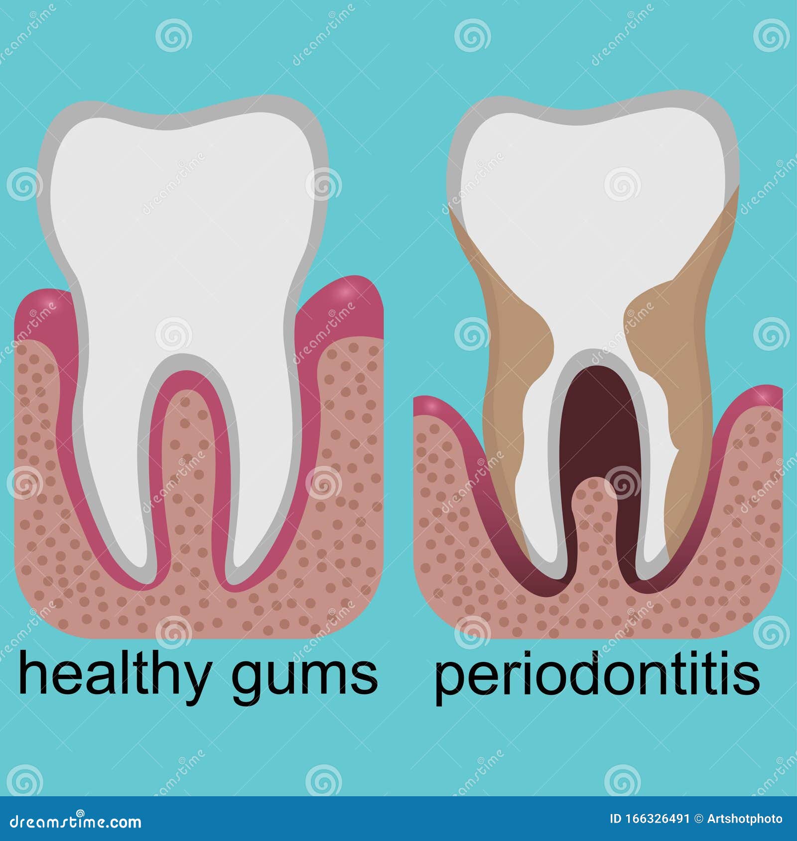 Periodontitis Complications Poster Vector Illustration | CartoonDealer ...