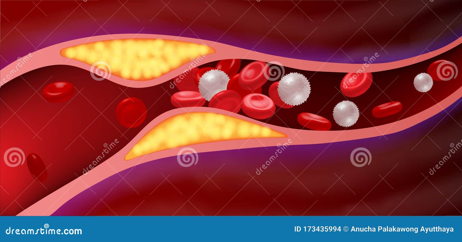 Arteries with Clogged Fat that Causes Blood Clots. Stock Vector ...