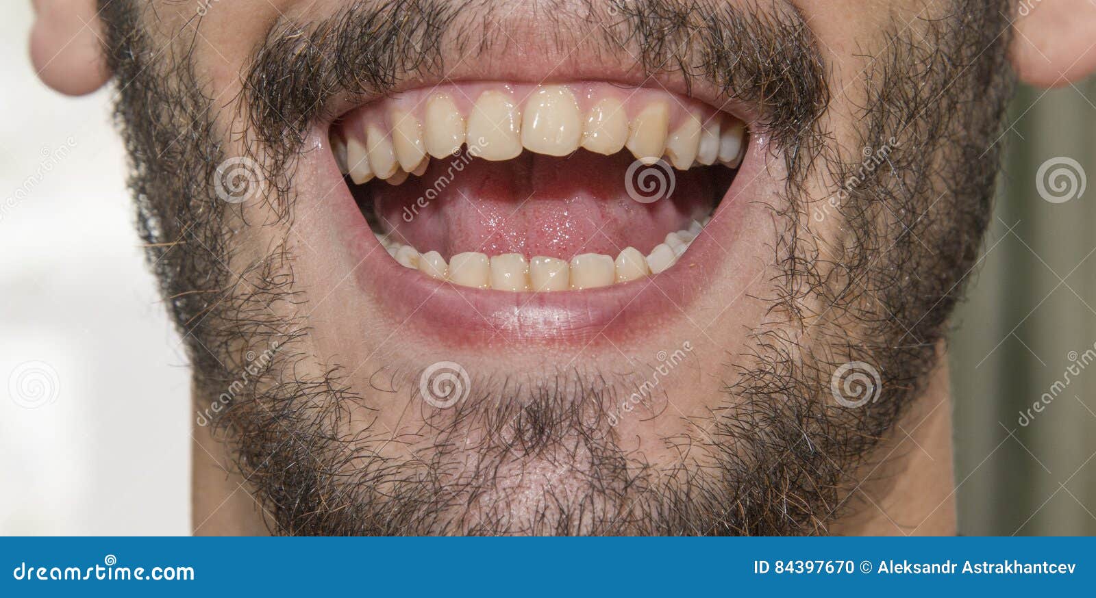 The Bearded Man Smiles, Showing Bad Teeth. Stock Photo - Image of close ...