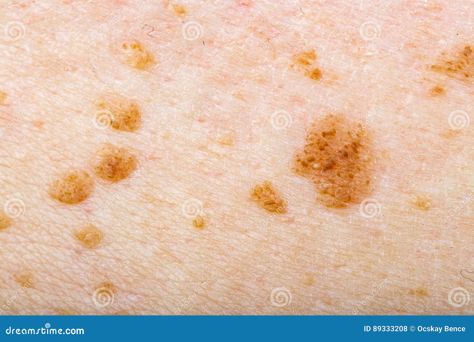 Beaucoup Naevus Sur La Peau Humaine Photo stock - Image du taupe ...