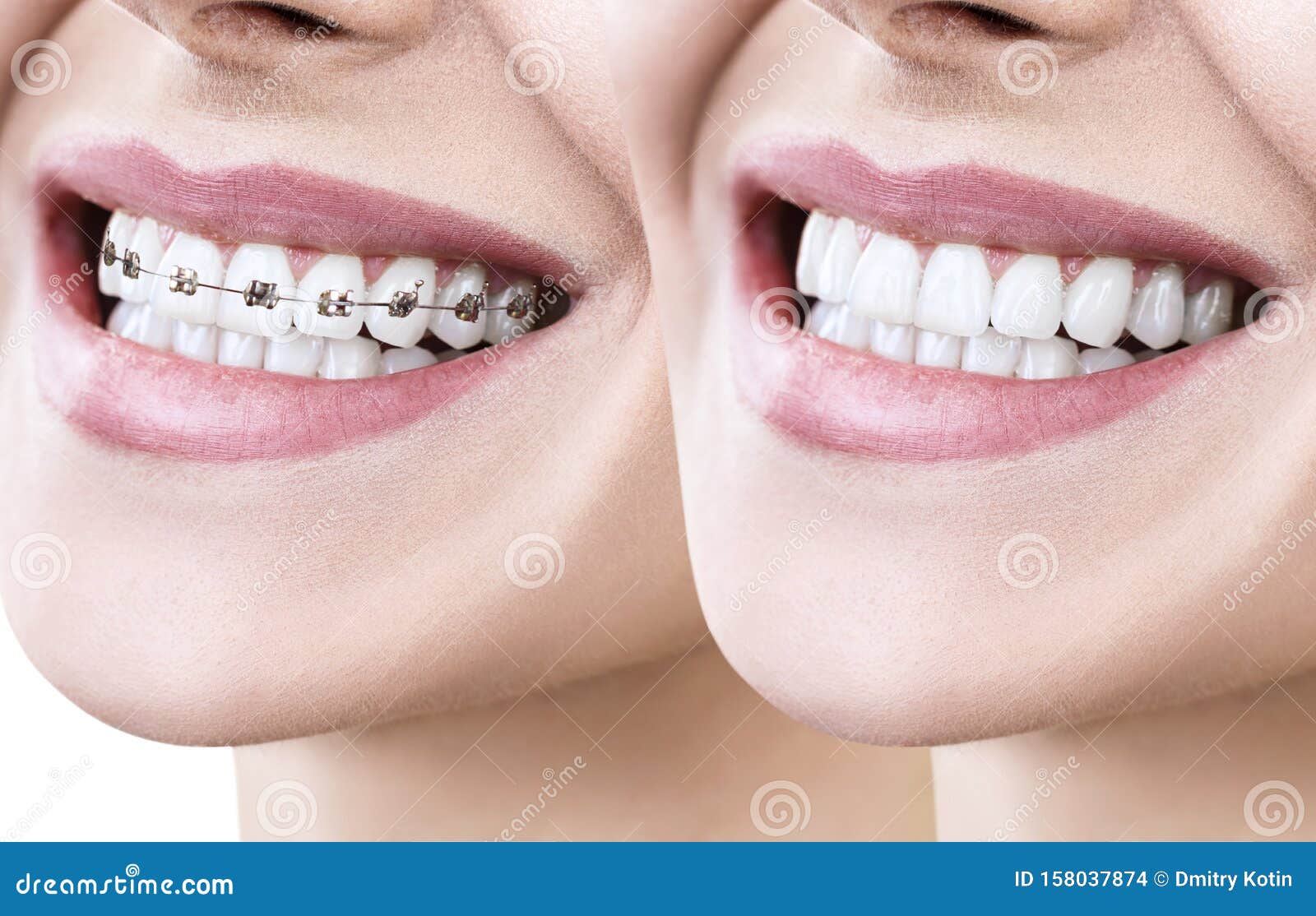 Beautiful Smile with Perfect Teeth before and after Braces. Stock Photo ... Beautiful Smile with Perfect Teeth before and after Braces. Stock Photo ...