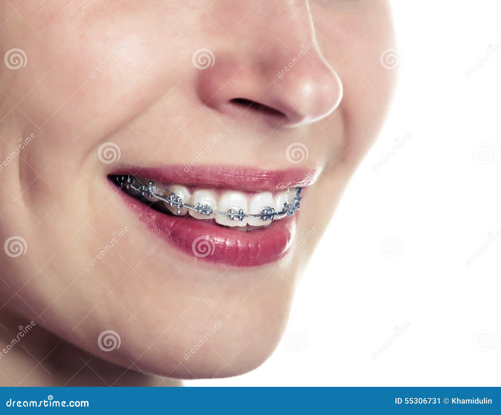 Beautiful Smiling Girl with Retainer for Teeth. Stock Image - Image of ...
