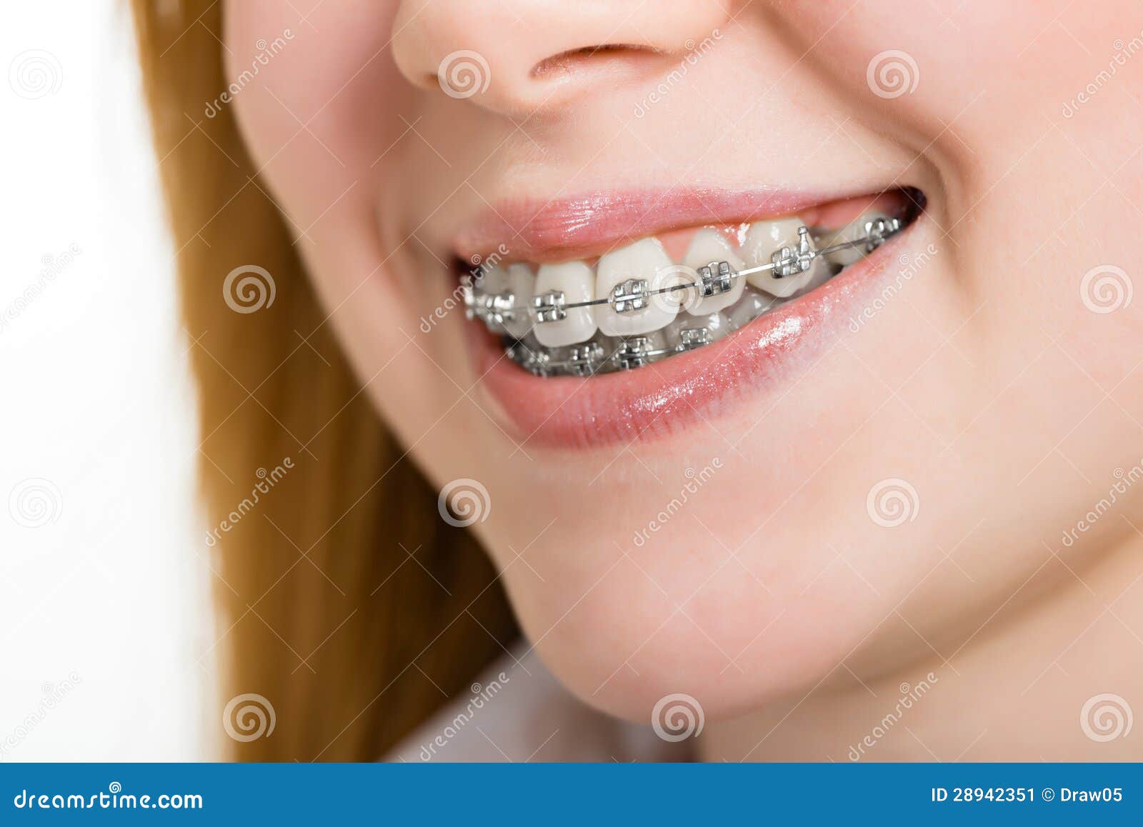 Beautiful Young Woman with Brackets on Teeth Stock Image - Image of ...