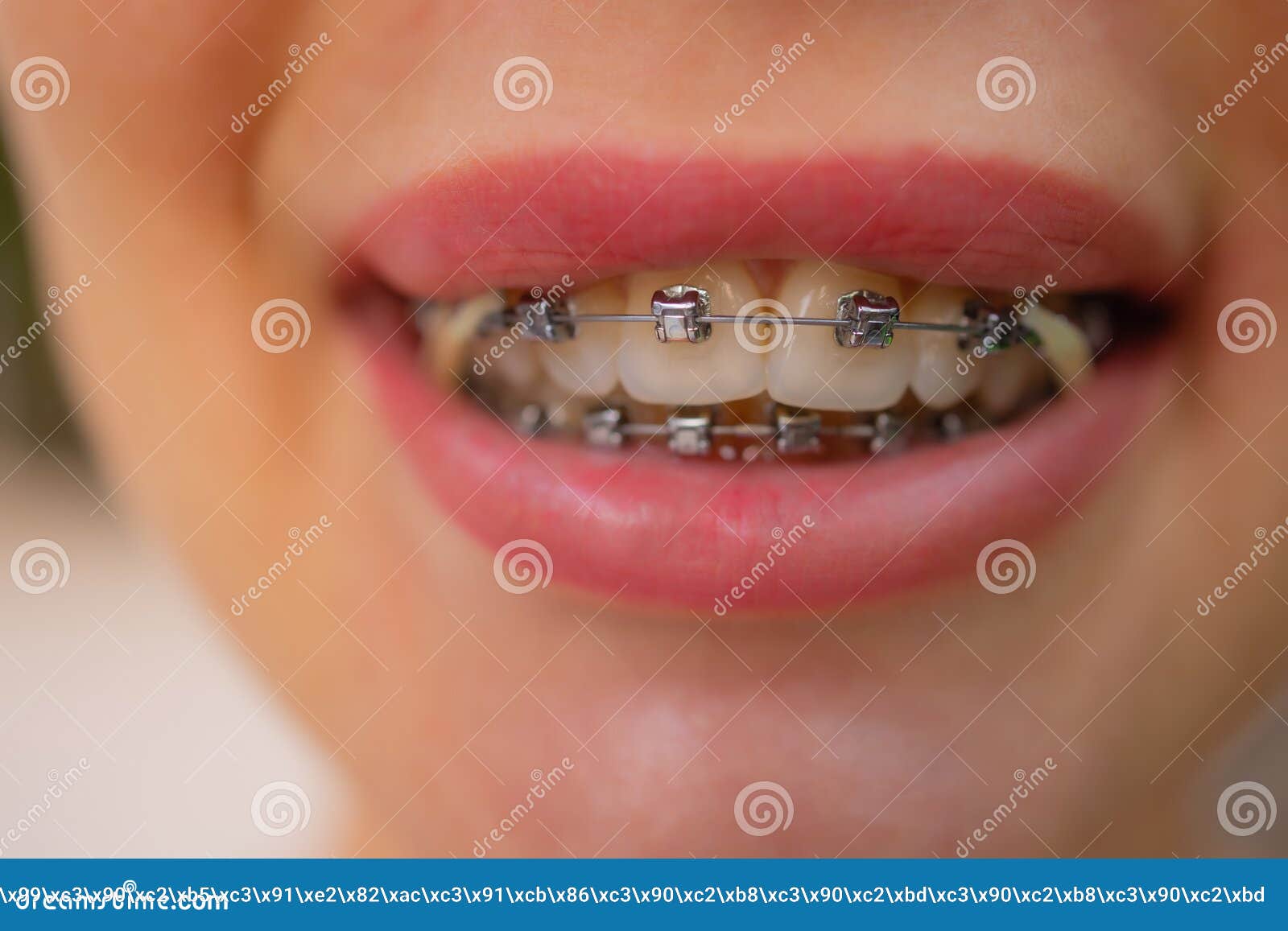 Beautiful Young Woman with Brackets on Teeth Close Up. Stock Photo ...