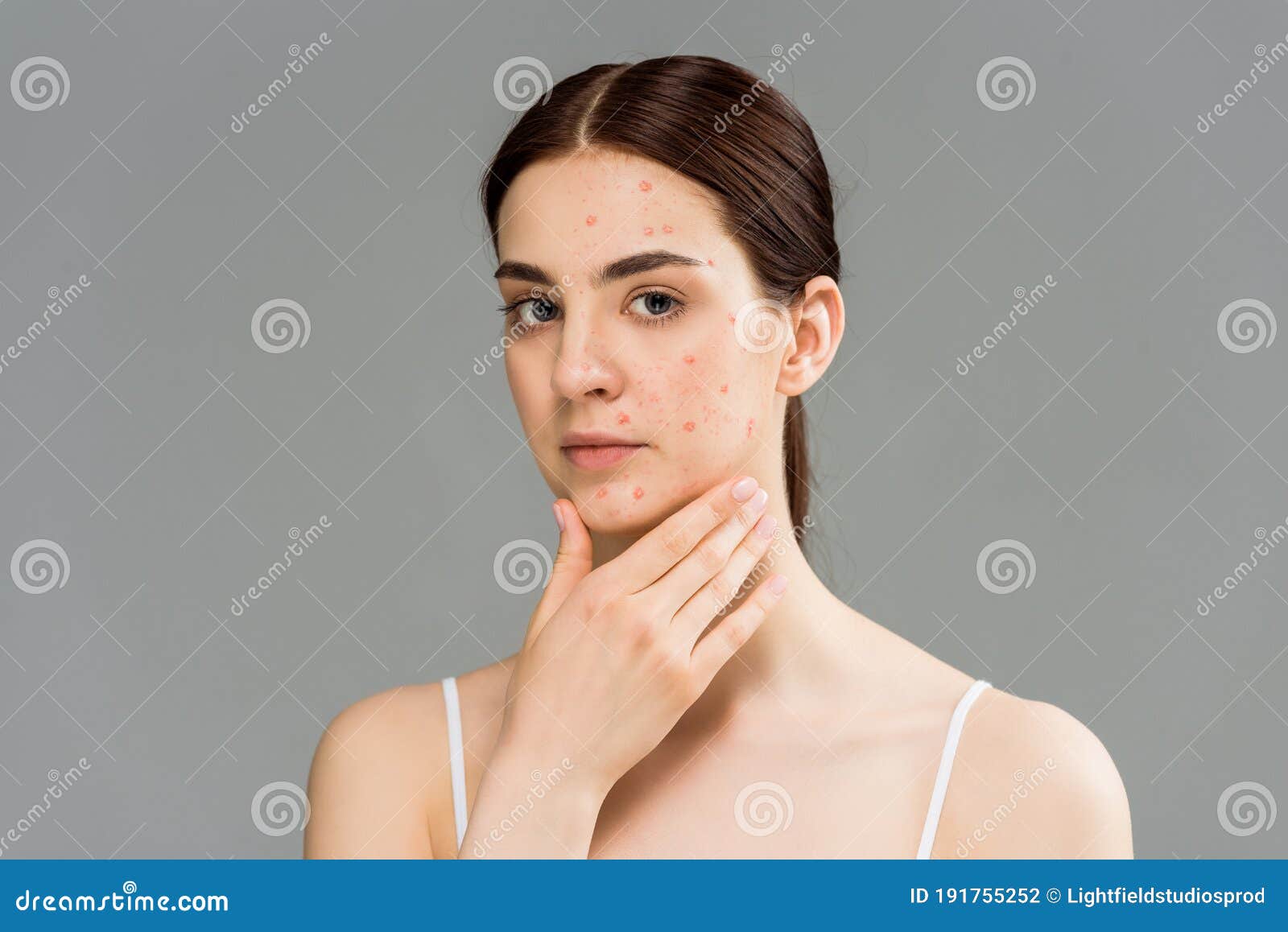 Young Woman with Pimples Touching Face on Grey Stock Photo - Image of ...