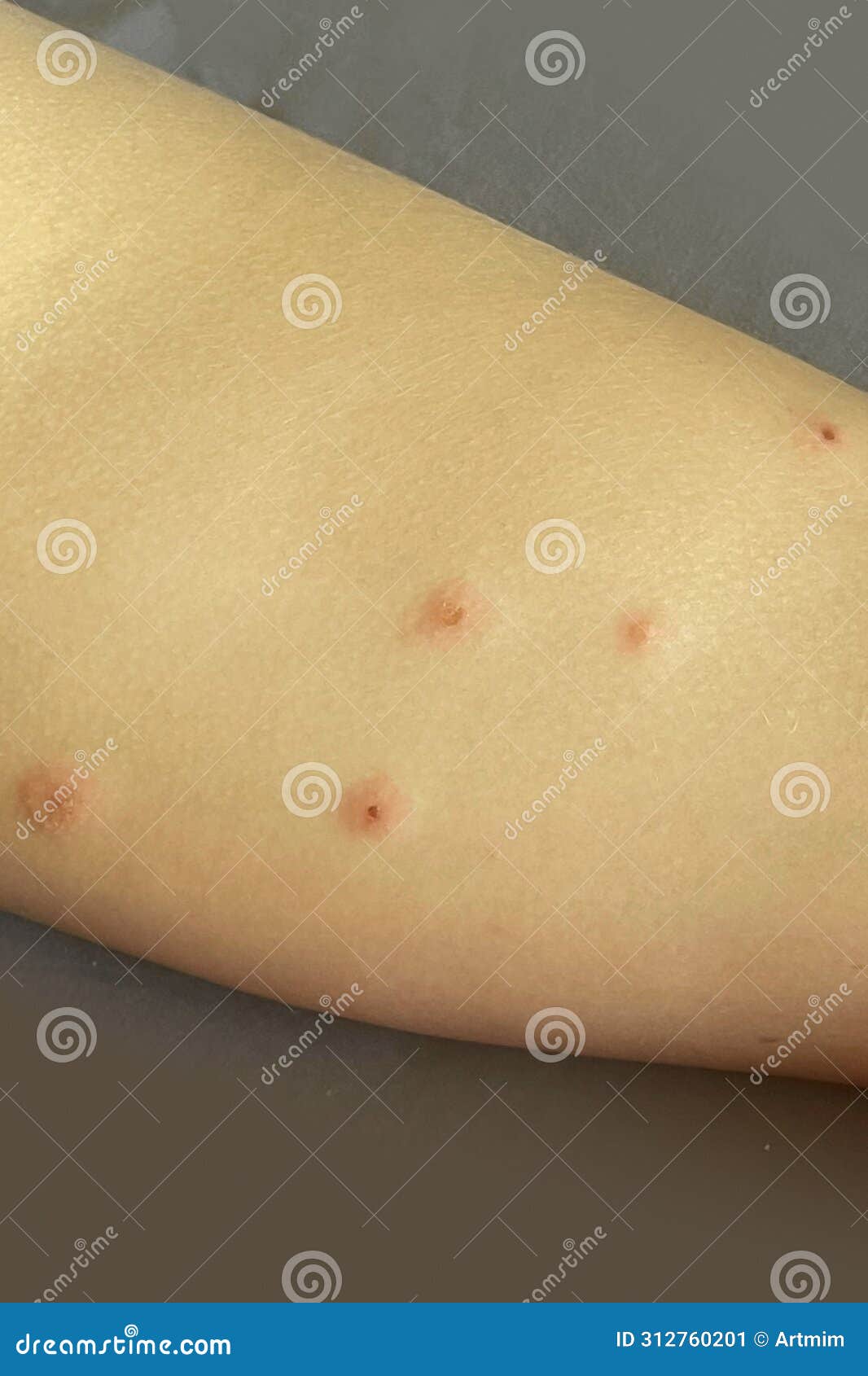 Staphylococcal, Streptococcal Skin Infection Or Bullous Impetigo And ...