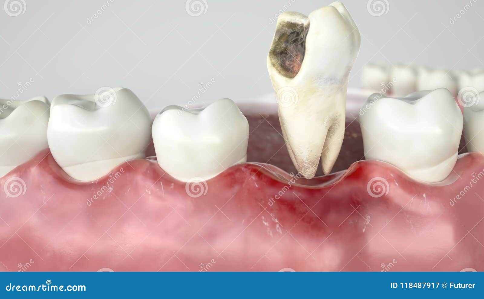 Bederf in Drie Stadia - Stadium 3 Tandextractie - Het 3D Teruggeven ...