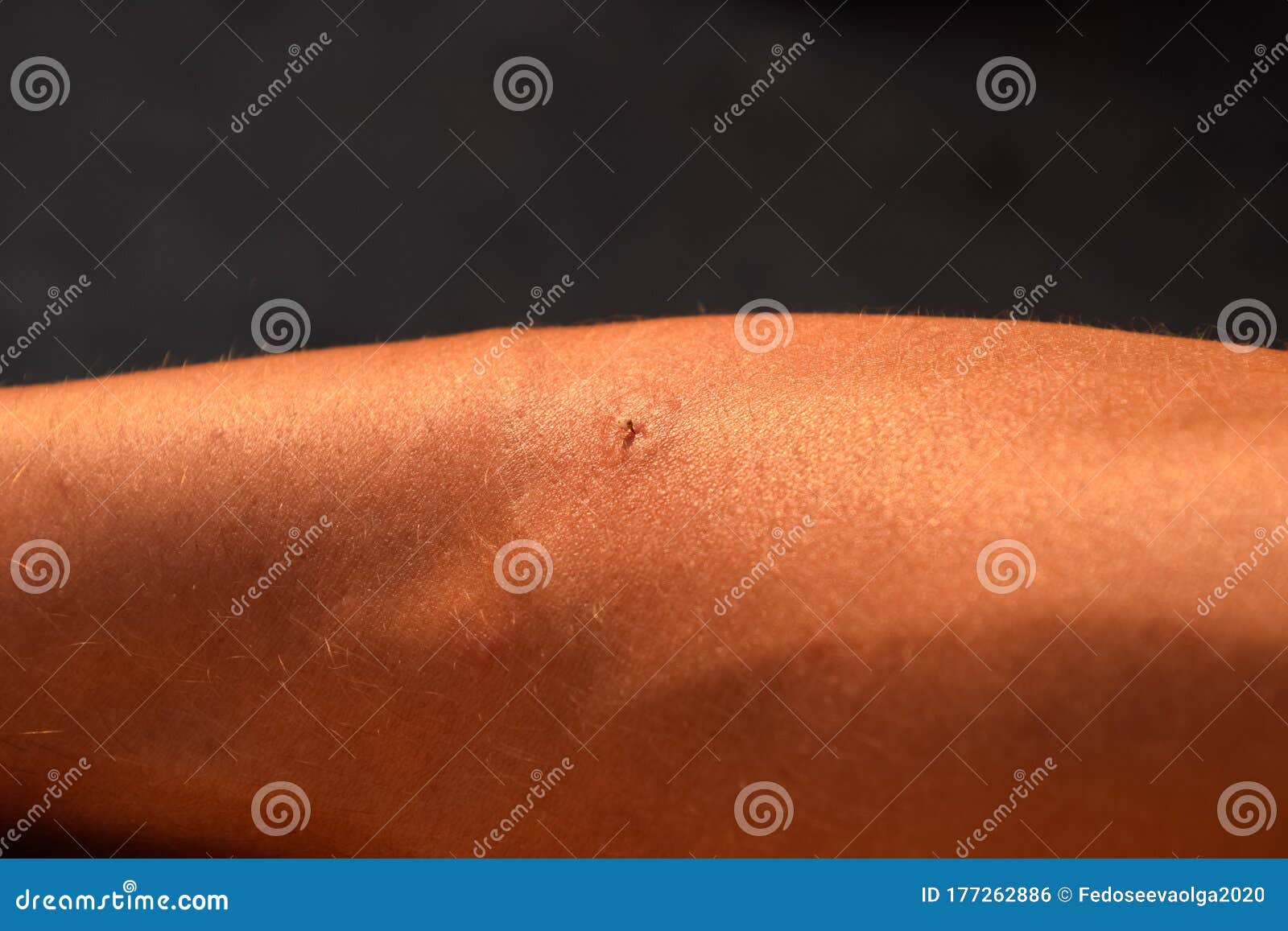 Bee Sting. Bee Sting in Human Skin. Consequences of Stinging with Bee ...