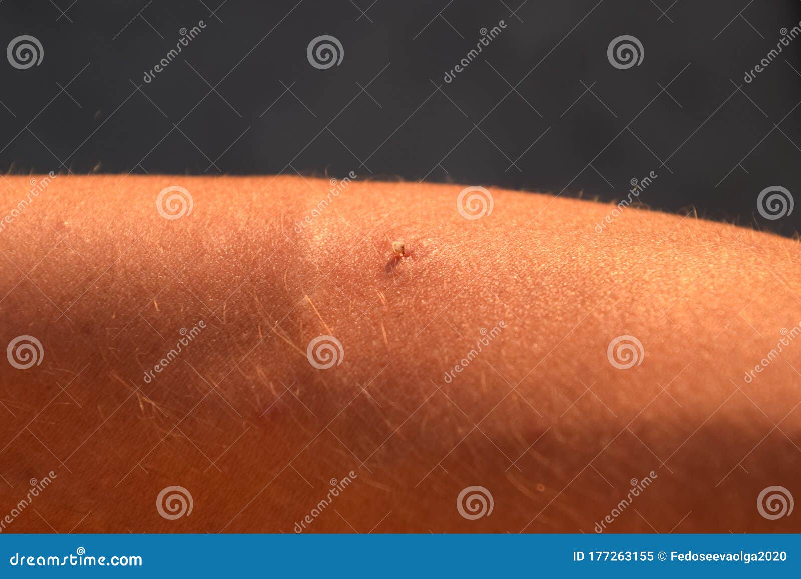 Bee Sting. Bee Sting In Human Skin. Consequences Of Stinging With Bee ...