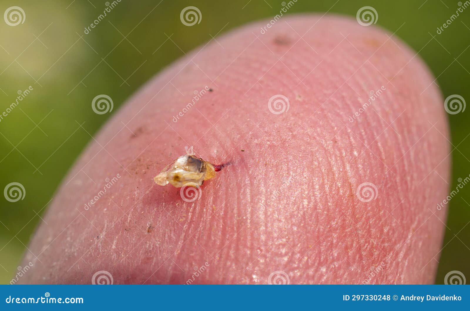 A Bee Stung a Mans Finger._ Stock Photo - Image of stung, alternative ...