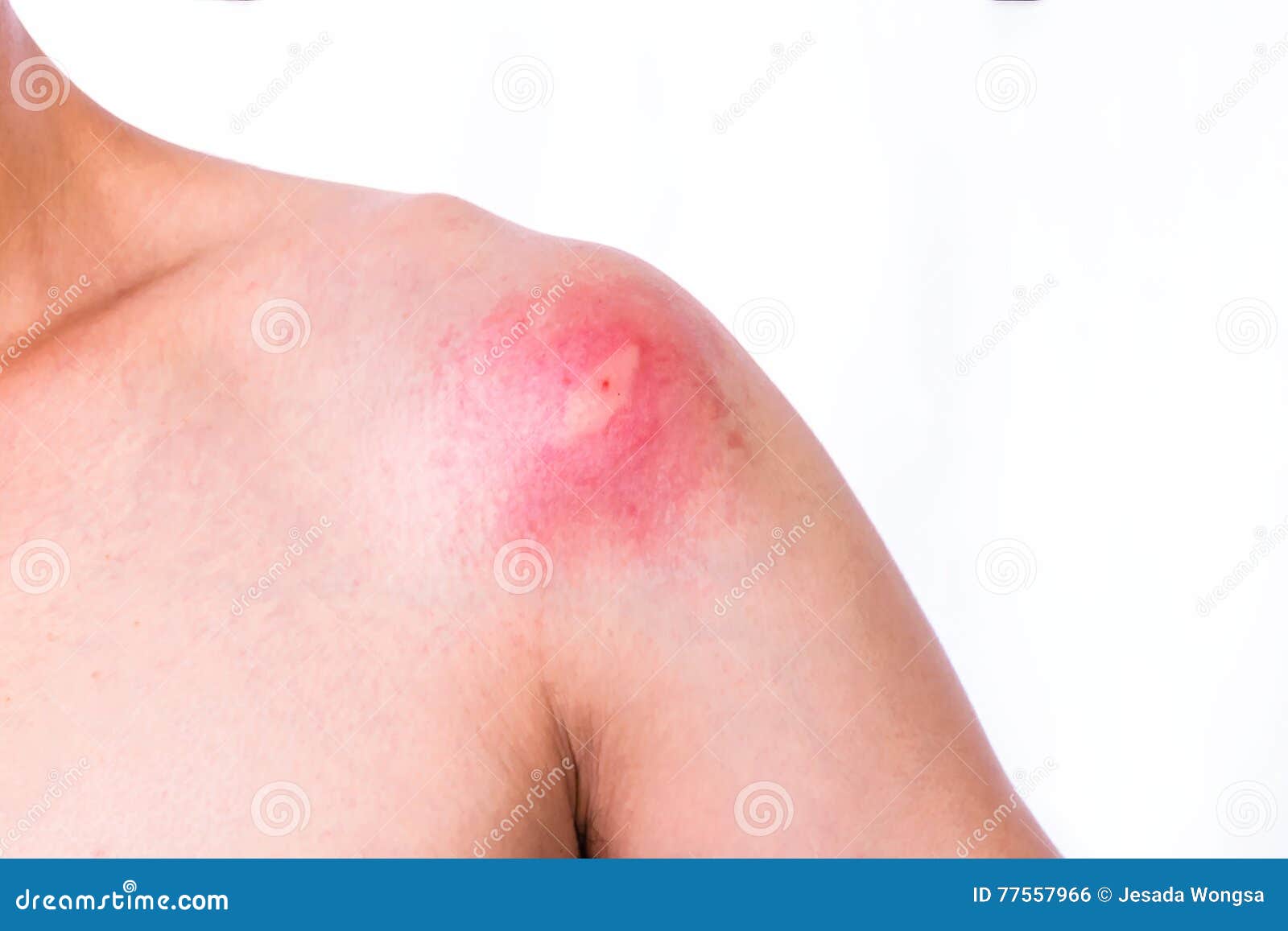 Bee, Wasps, Insect Bite Sting on the Skin Stock Photo - Image of ...