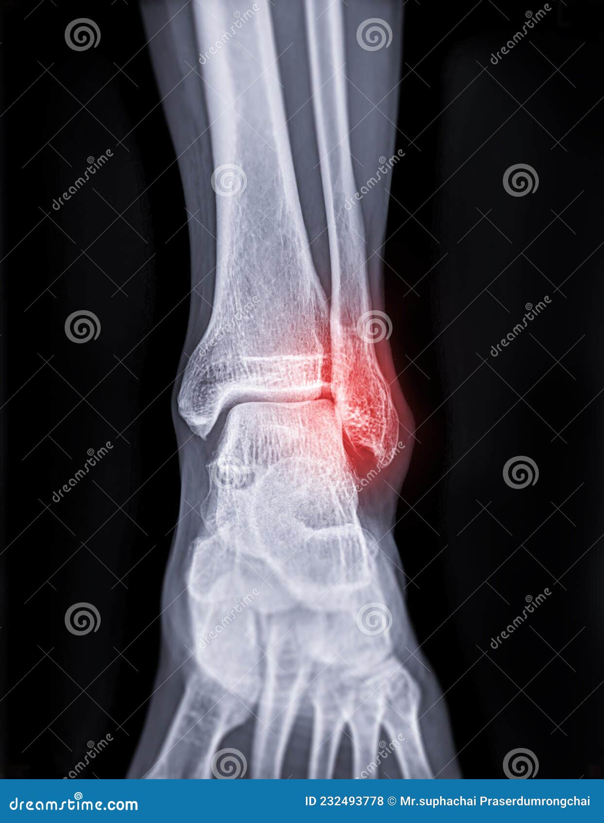 Beeld Van Enkelgewricht Met Breuken Van Enkelgewricht Stock Foto ...