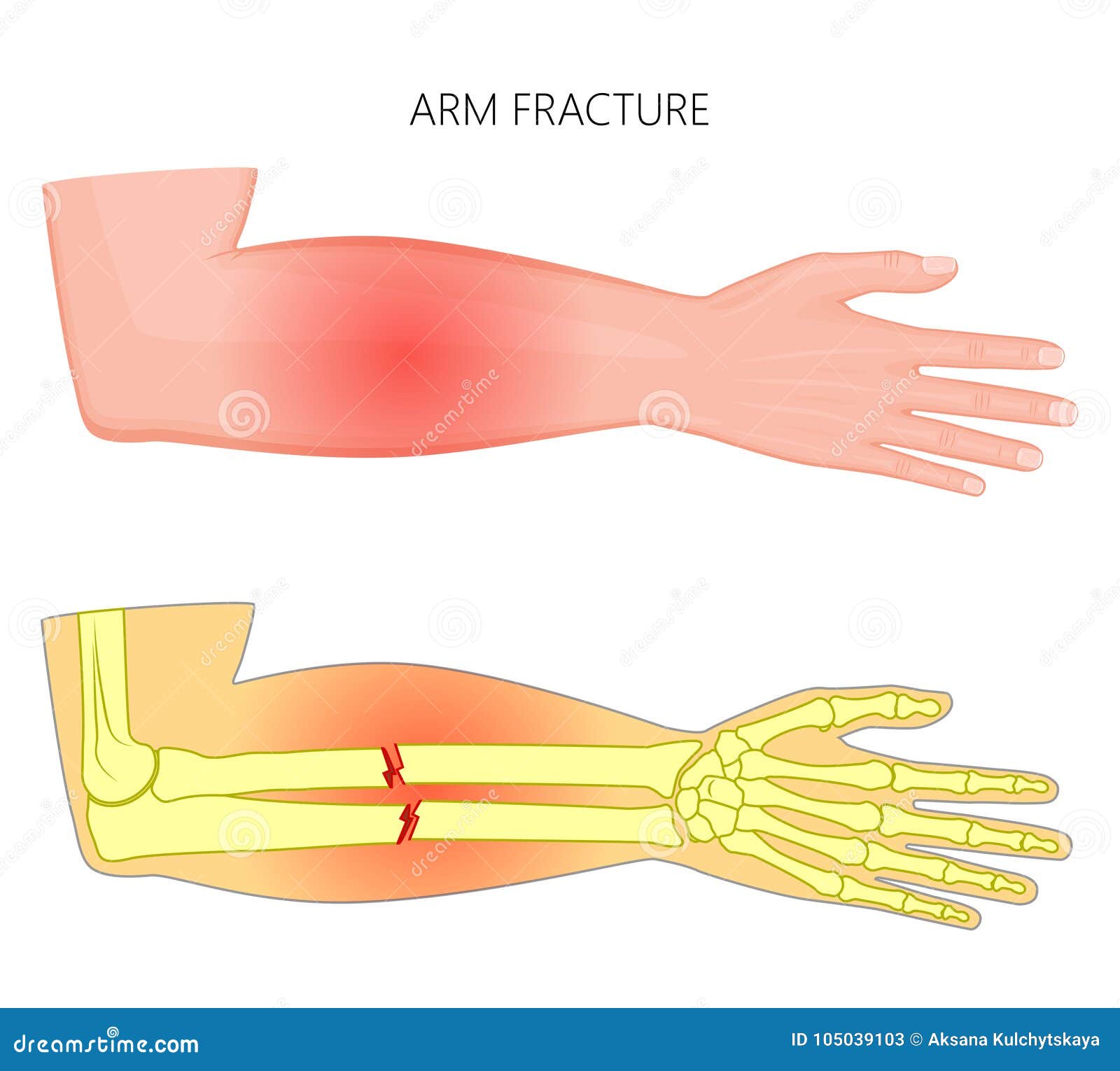 Been fracture_Hand breuk vector illustratie. Illustration of breuk ...