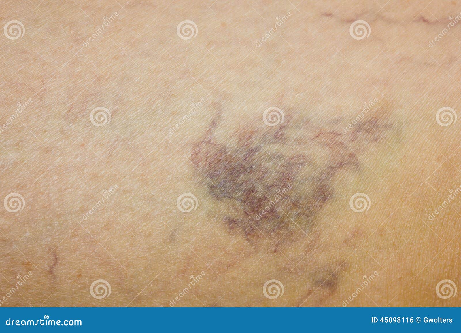 Been met spataders stock foto. Image of been, idiopathisch - 45098116