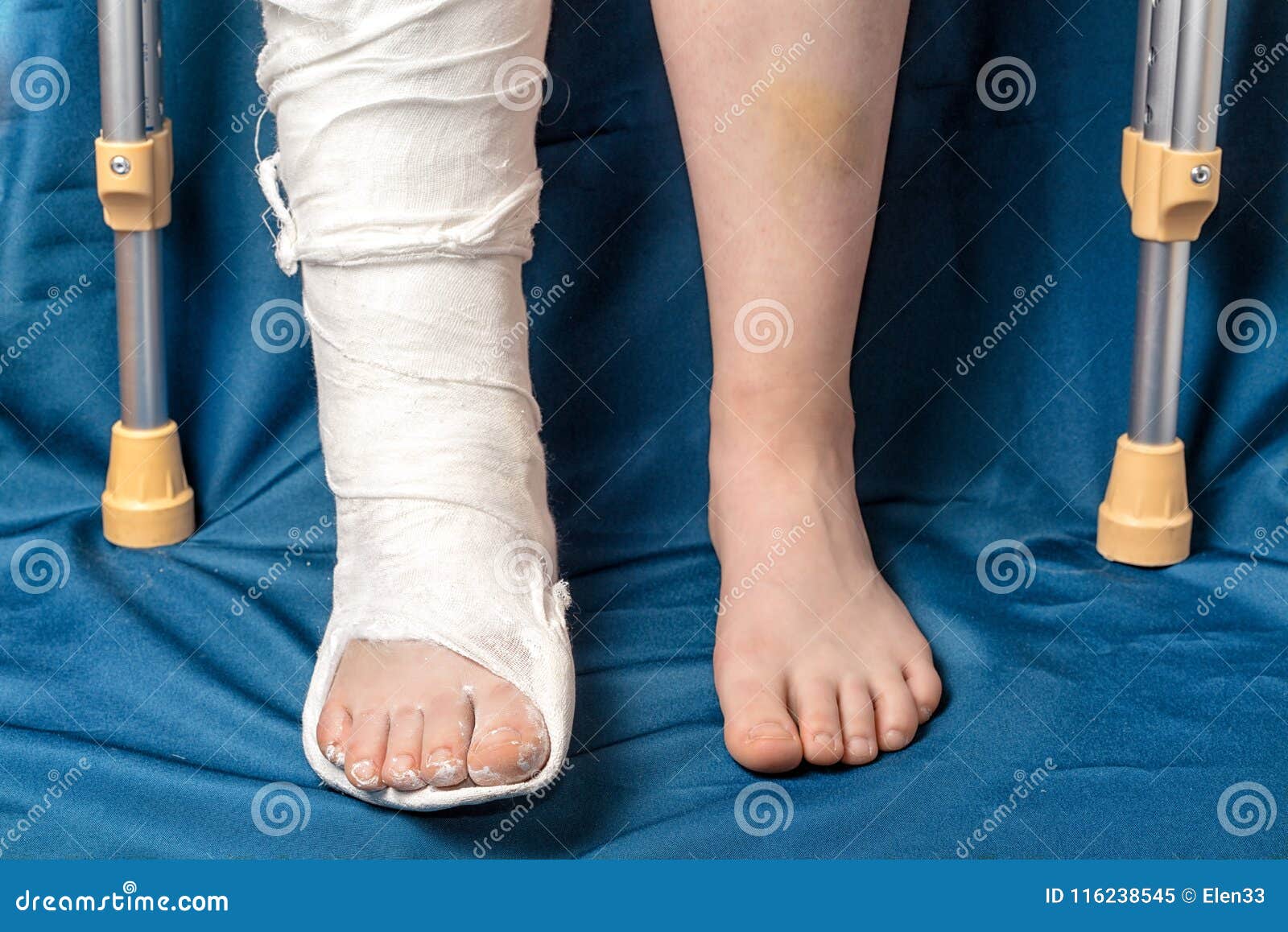 Beenbreuk In Gips En Steunpilaren Stock Afbeelding - Afbeelding ...