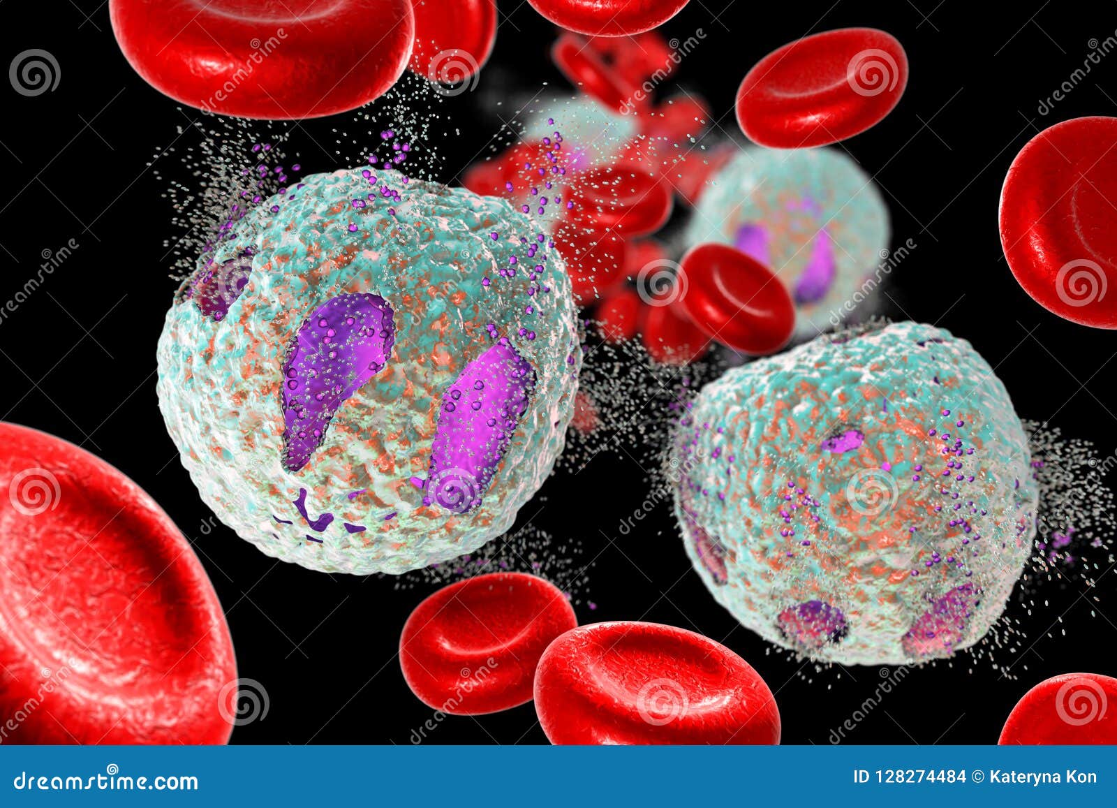 Behandeling Van Scherpe Lymphoblastic Leukemie Stock Illustratie ...