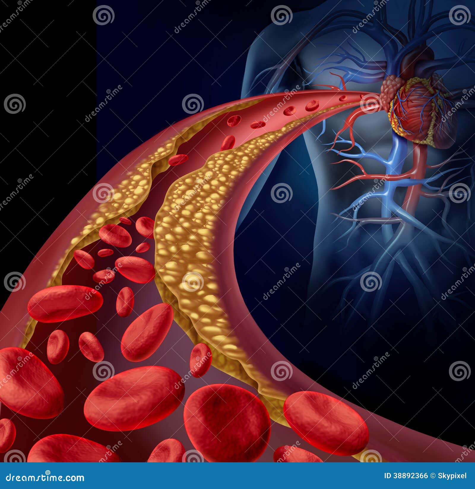Belemmerde Slagader stock illustratie. Illustration of menselijk - 38892366