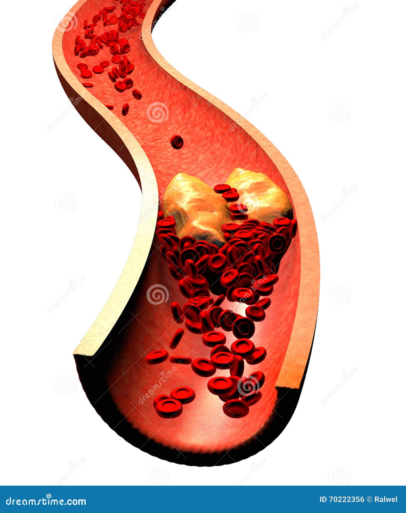 Belemmerde Slagader Met Plaatjes En Cholesterolplaque, Stock ...