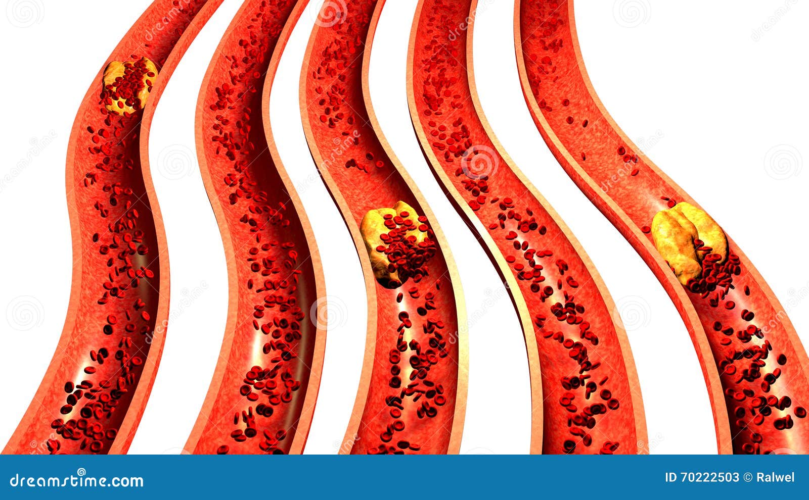 Belemmerde Slagader Met Plaatjes En Cholesterolplaque, Stock ...