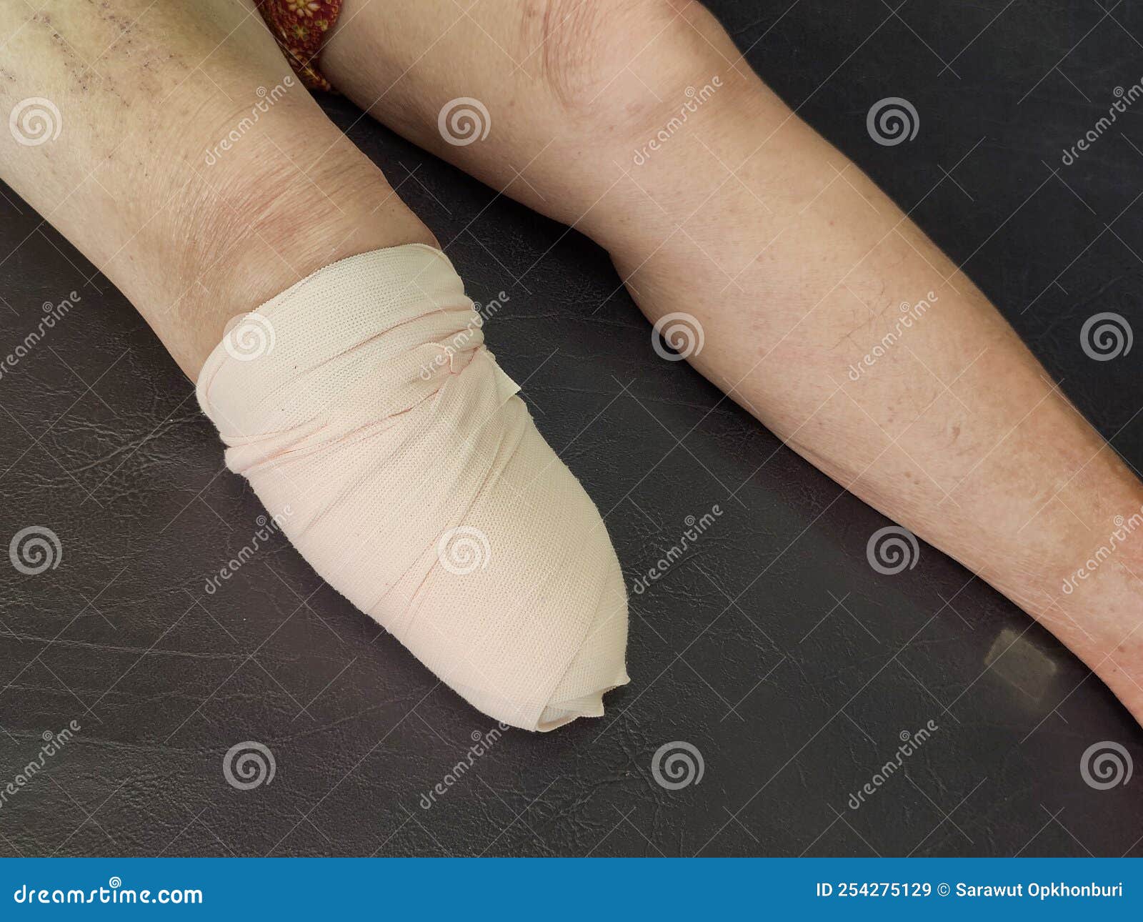 Below Knee Amputation Bandaging for BK Prosthesis Stock Image - Image ...