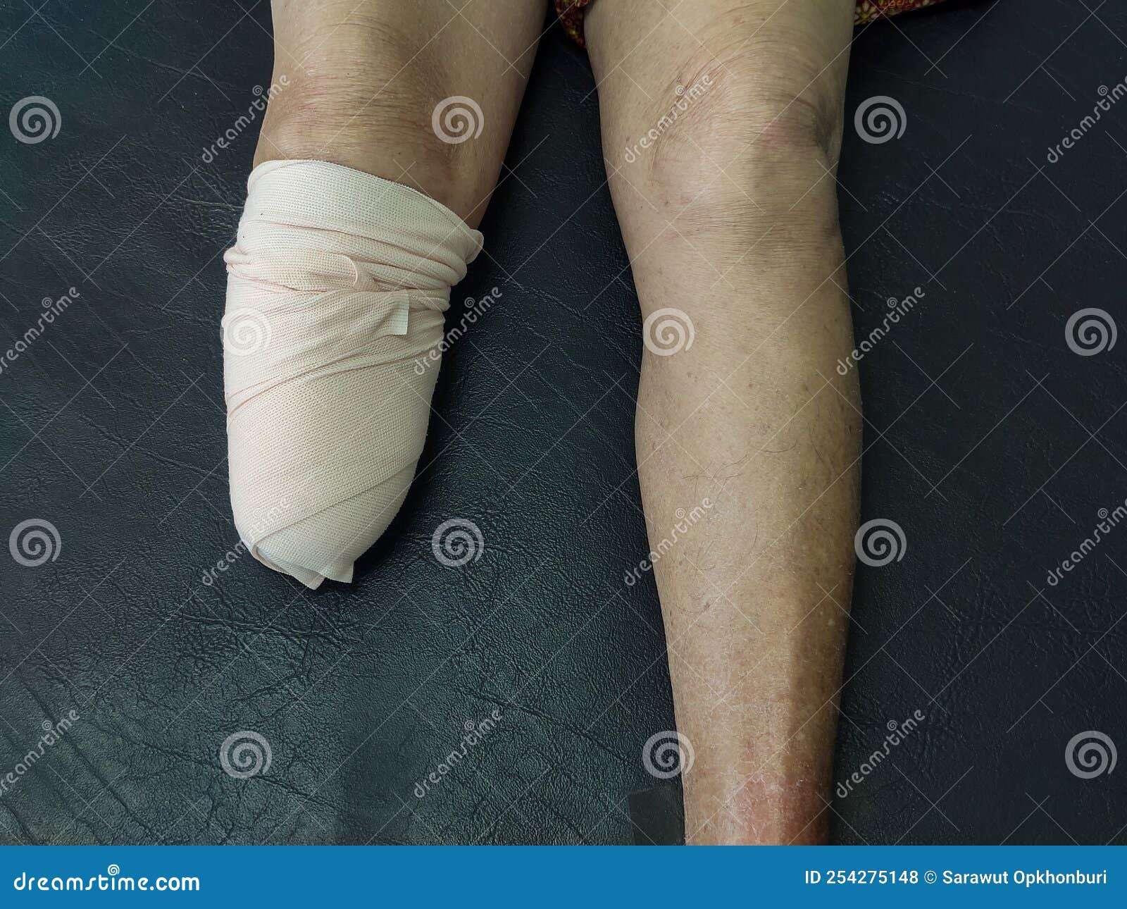Below Knee Amputation Bandaging for BK Prosthesis Stock Photo - Image of assistance, illness ...