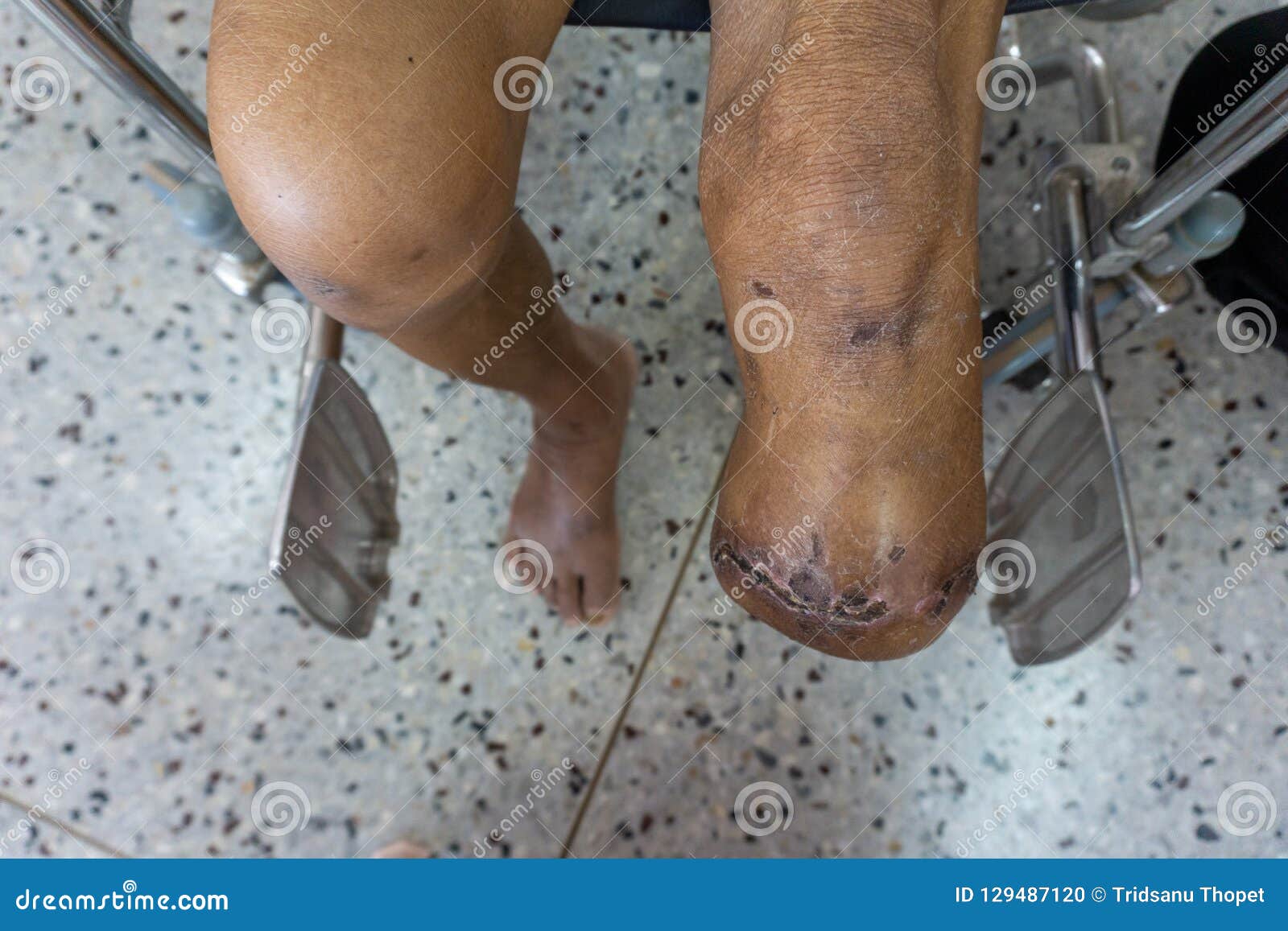 Below knee amputation stock photo. Image of body, bandaging - 129487120