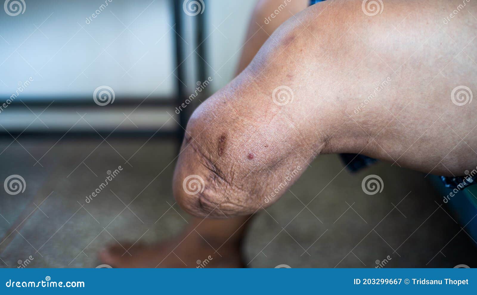 Below Knee Amputation Stump and Muscle Training Stock Image - Image of ...