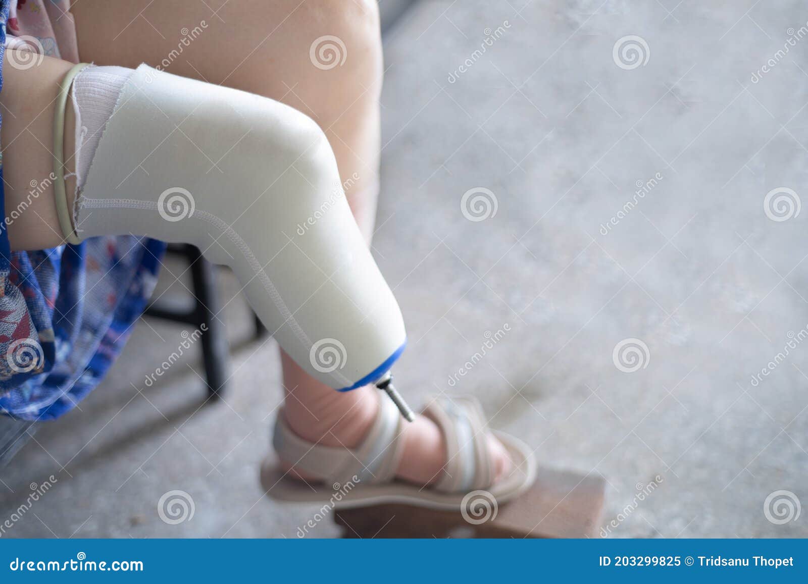 Below Knee Amputation Stump and Muscle Training Stock Image - Image of ...