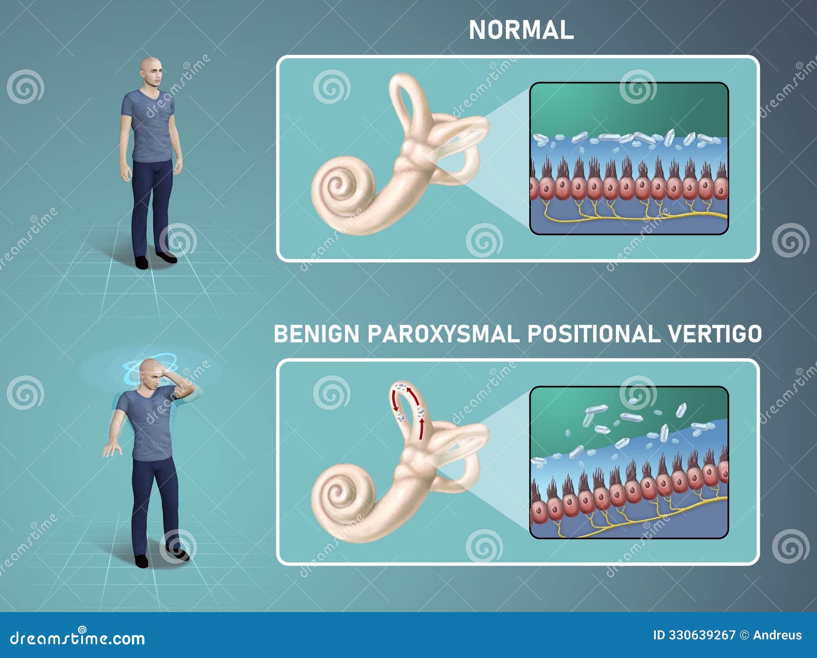 BPPV Or Benign Paroxysmal Positional Vertigo Syndrome Outline Diagram ...