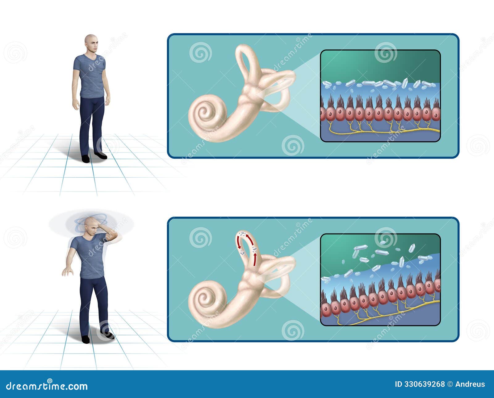 BPPV Or Benign Paroxysmal Positional Vertigo Syndrome Outline Diagram ...