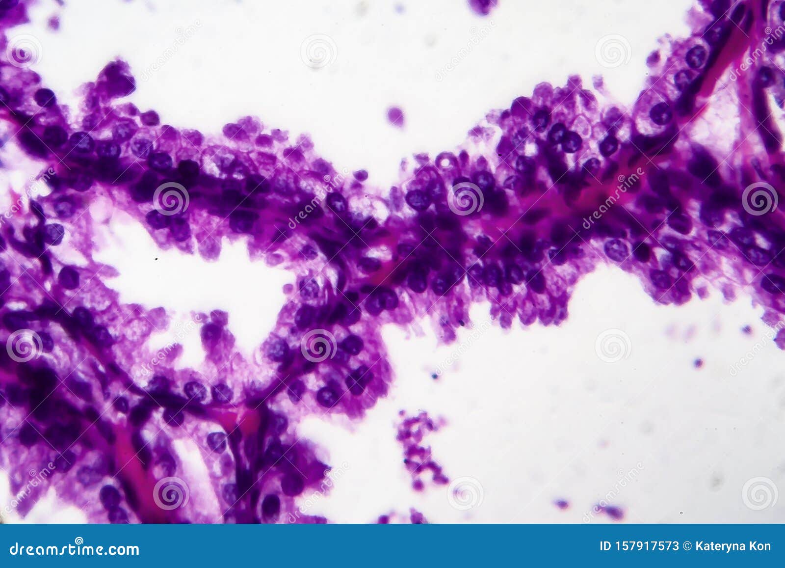 Benign Prostatic Hyperplasia Stock Image - Image of micrograph, cell ...