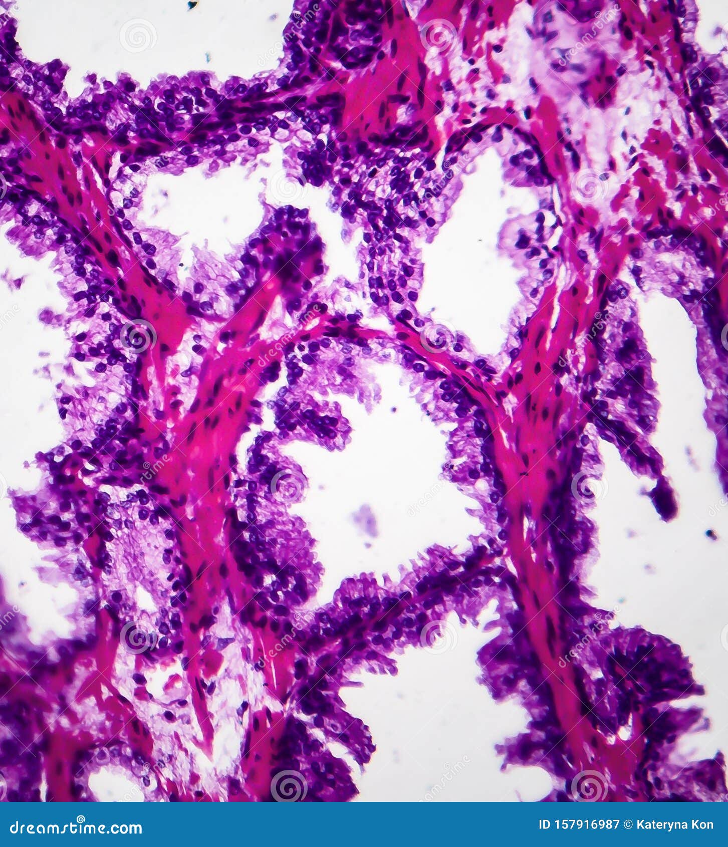 Benign Prostatic Hyperplasia Stock Image - Image of analysis ...