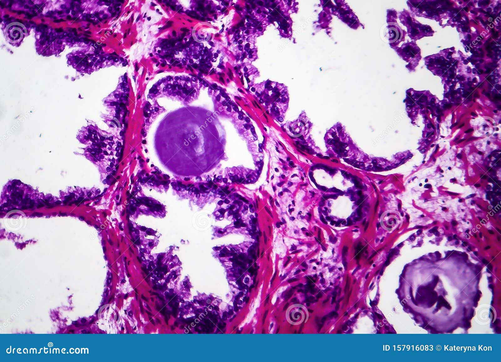 Benign Prostatic Hyperplasia Stock Image - Image of histology, core ...