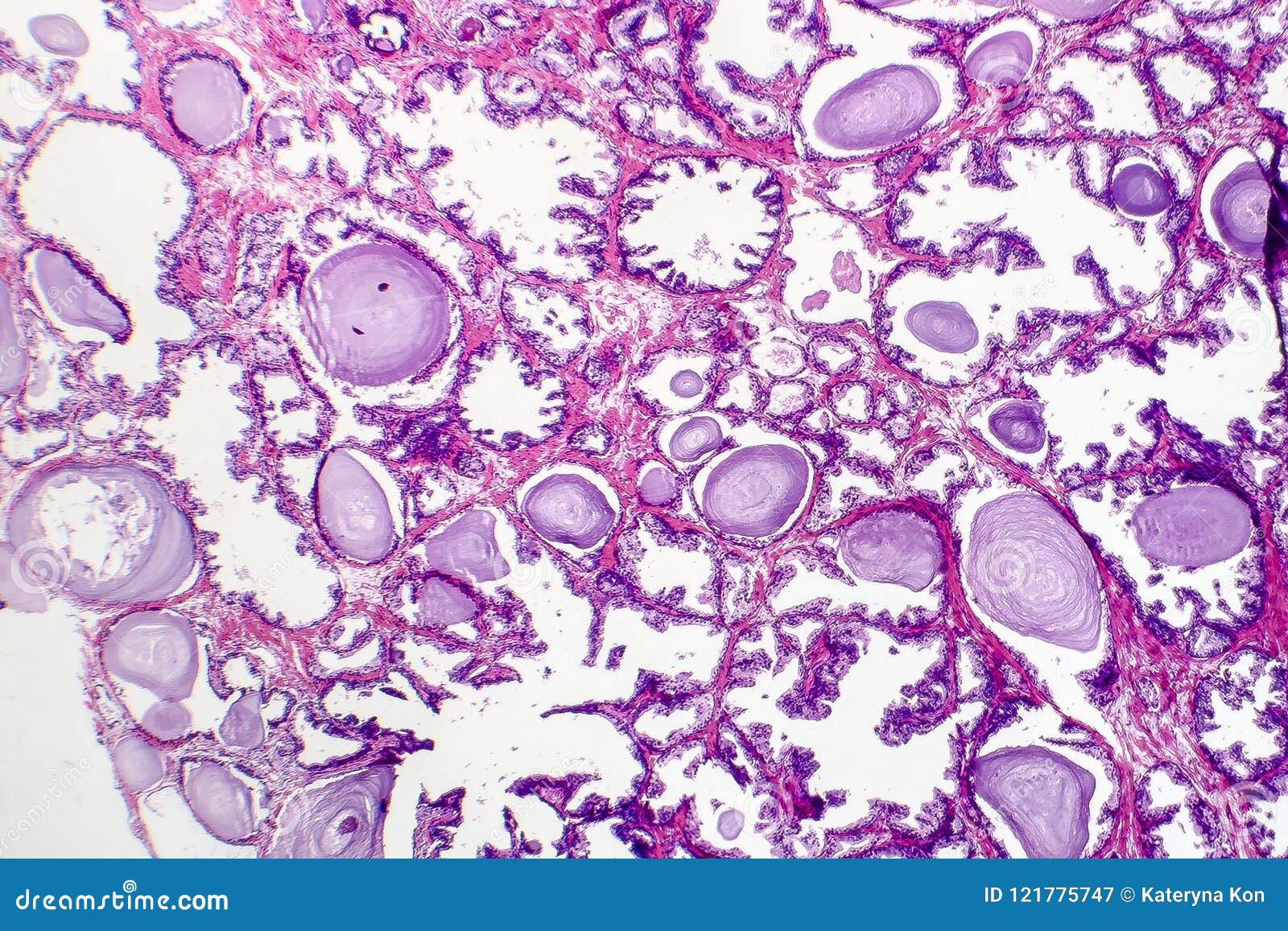 Benign Prostatic Hyperplasia Stock Image - Image of laboratory, biopsy ...