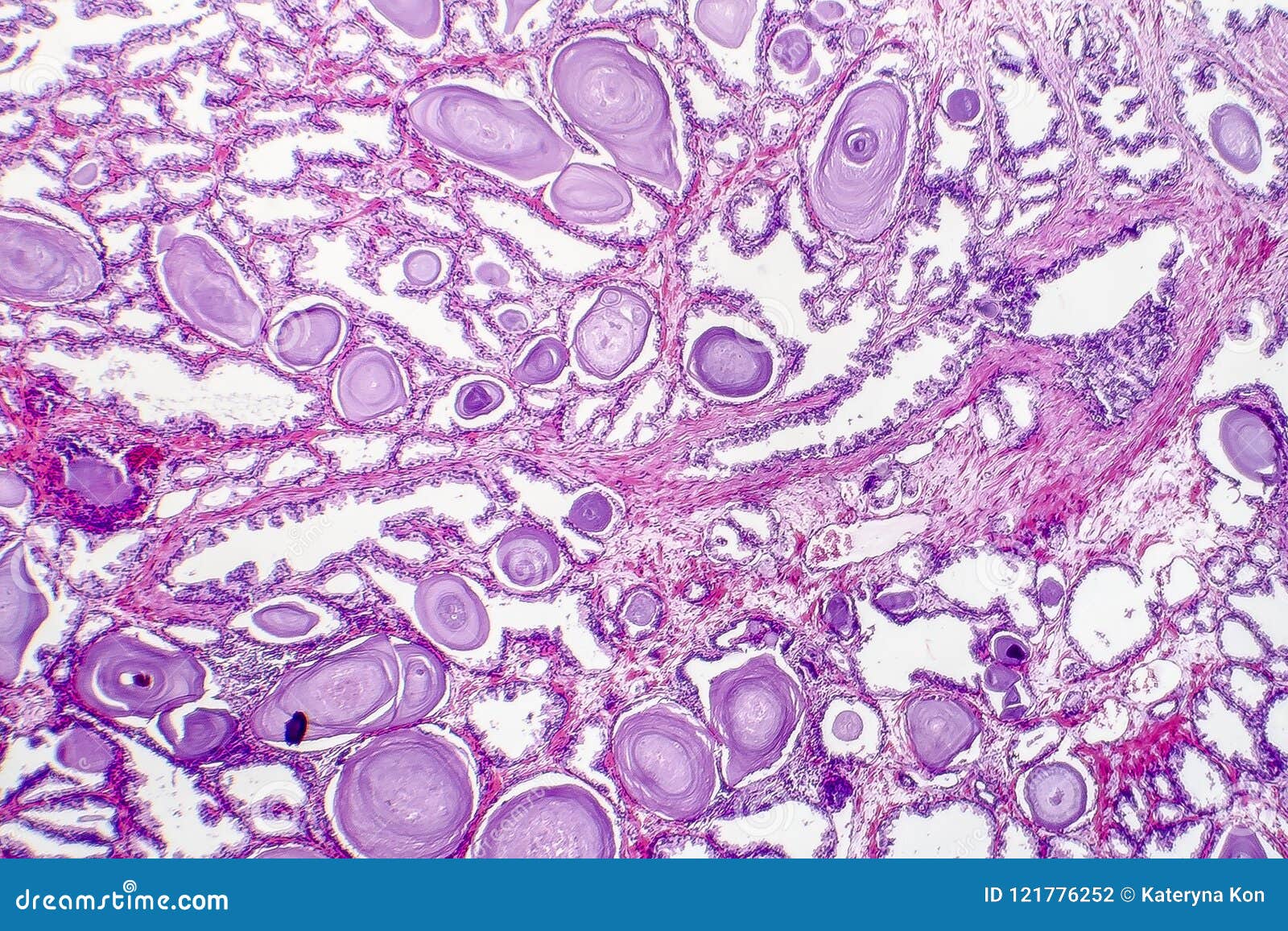 Benign Prostatic Hyperplasia Stock Photo - Image of morphological ...