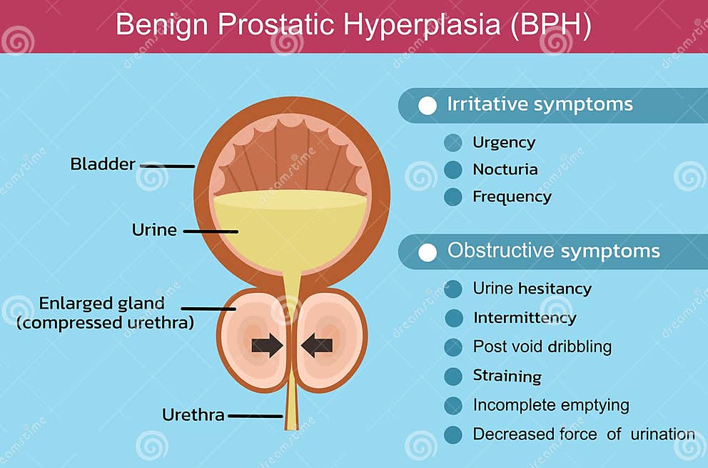 Benign Prostatic Hyperplasia (BPH) , Vector Stock Vector - Illustration ...
