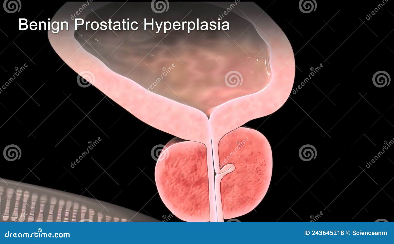 Benign Prostatic Hyperplasia 3d Medical Stock Illustration ...