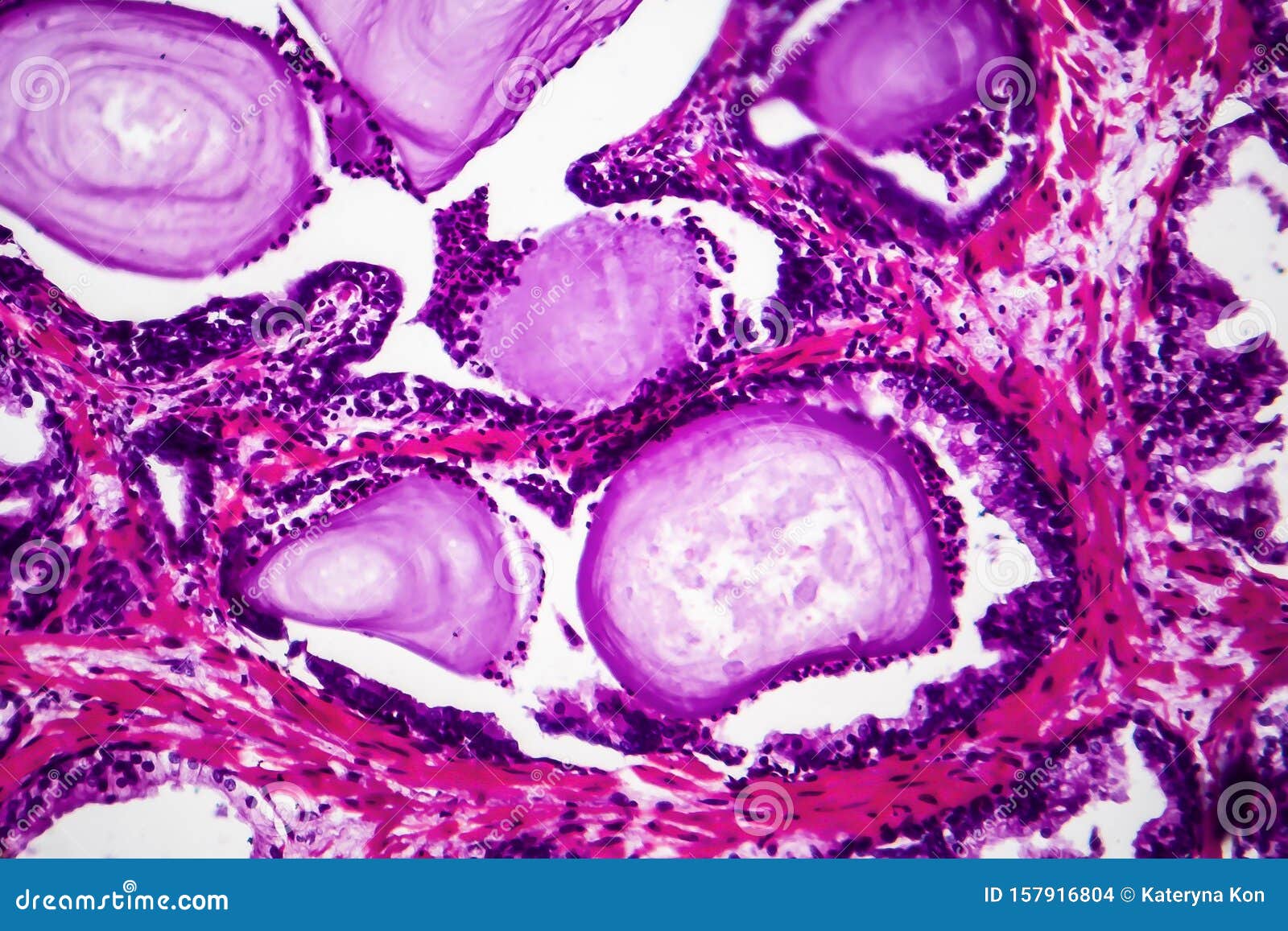 Benign Prostatic Hyperplasia Stock Photo - Image of microscopic ...