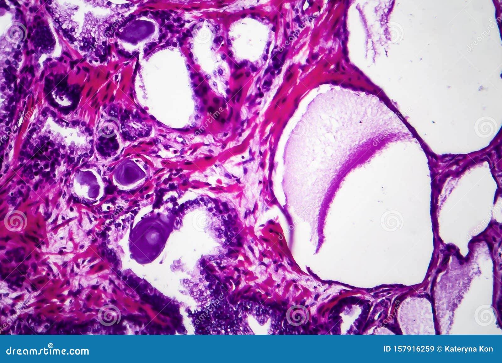 Benign Prostatic Hyperplasia Stock Image - Image of biopsy, diagnosis ...