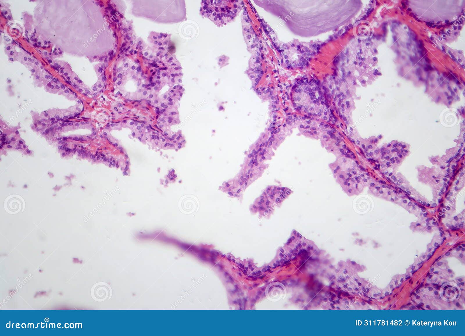 Benign Prostatic Hyperplasia, Light Micrograph Stock Photo - Image of ...