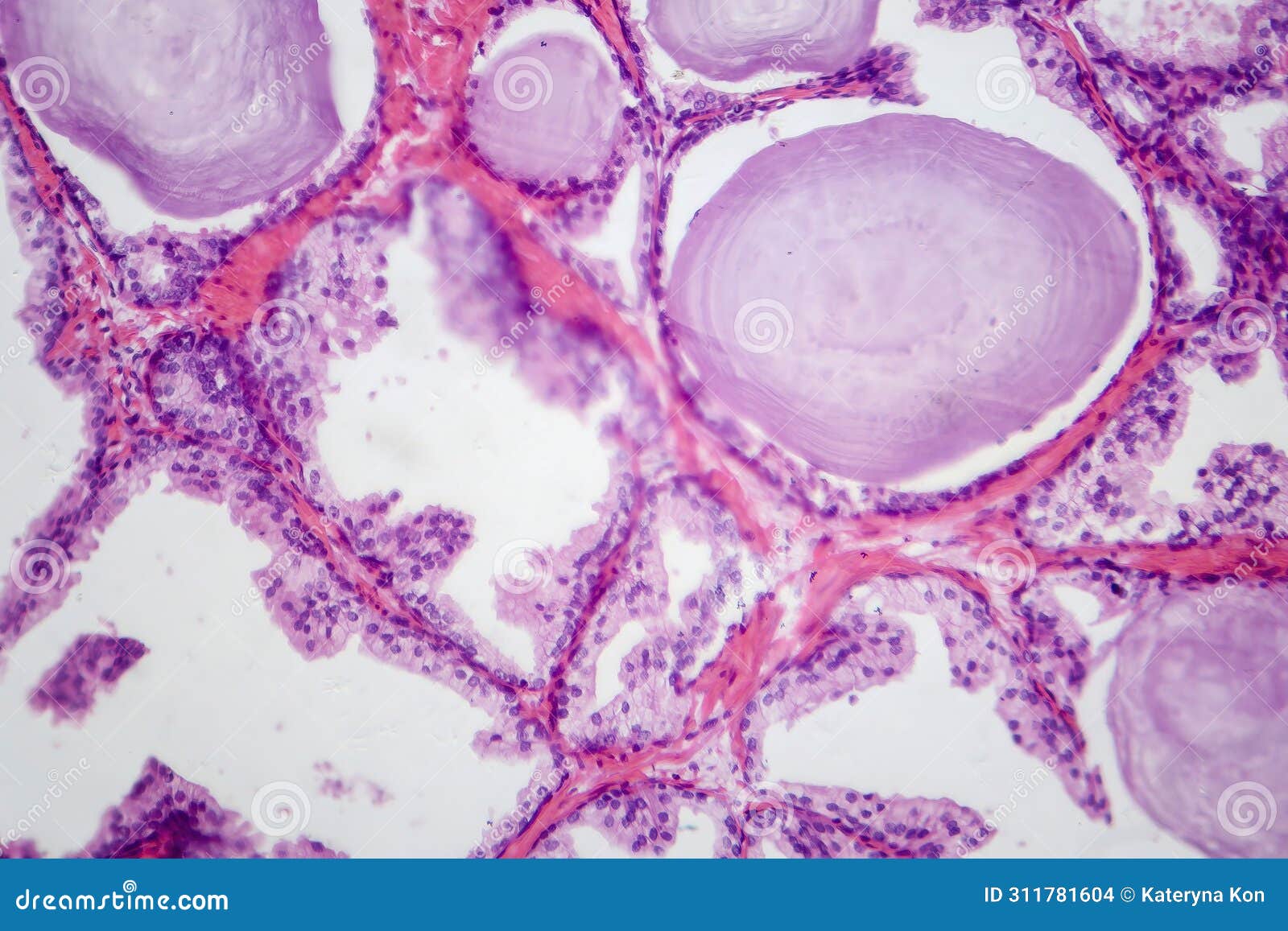 Benign Prostatic Hyperplasia, Light Micrograph Stock Photo - Image of ...