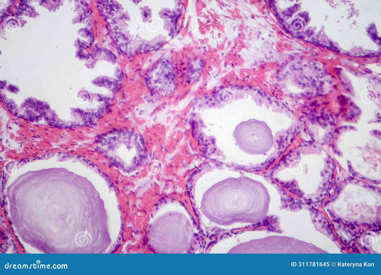 Benign Prostatic Hyperplasia Light Micrograph Stock Image Image Of