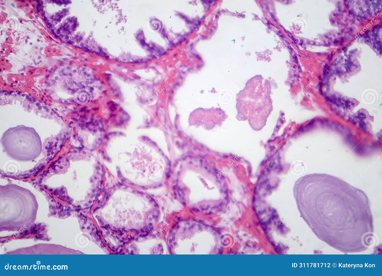 Benign Prostatic Hyperplasia, Light Micrograph Stock Photo - Image of ...