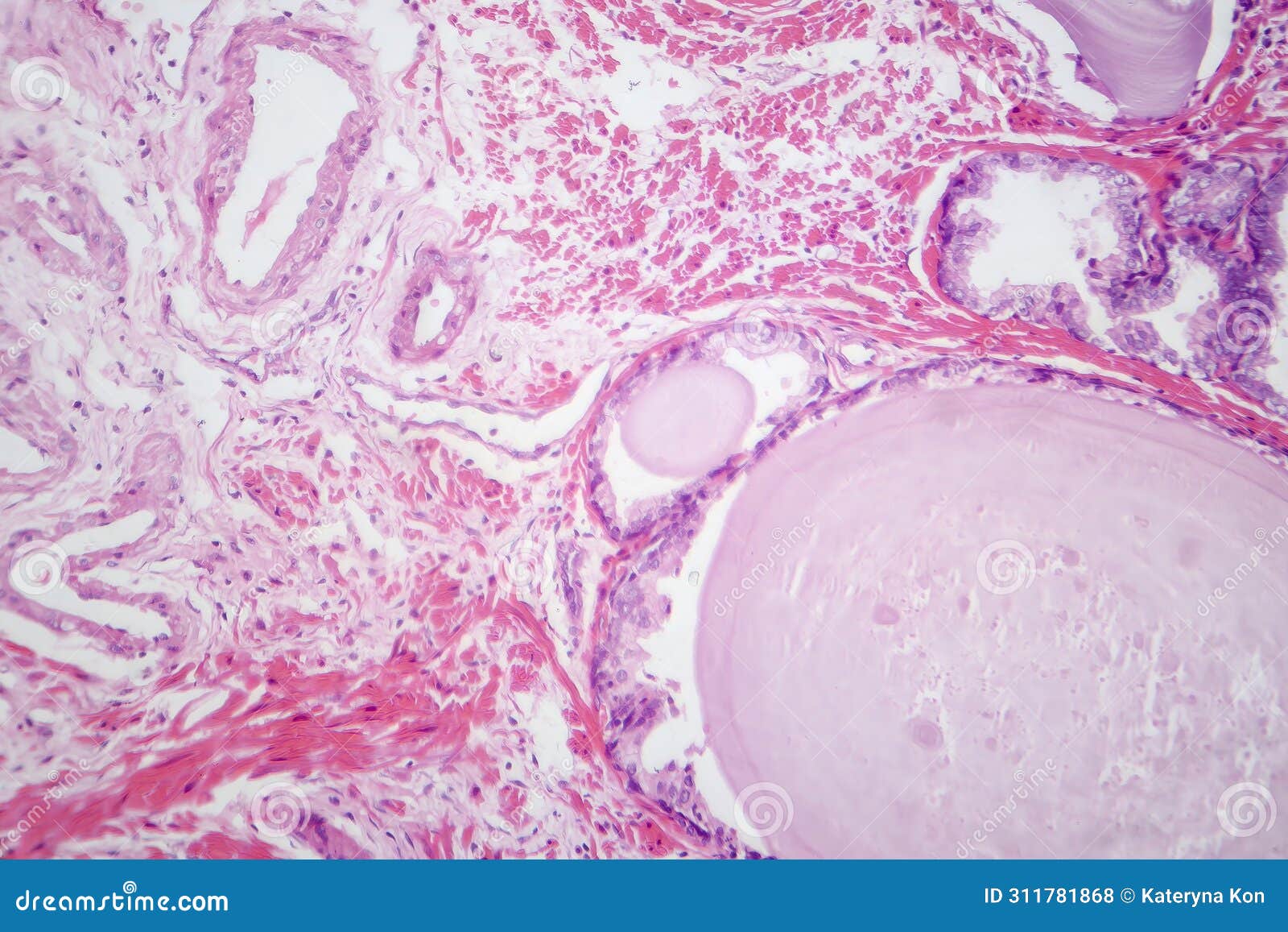 Benign Prostatic Hyperplasia, Light Micrograph Stock Photo - Image of ...