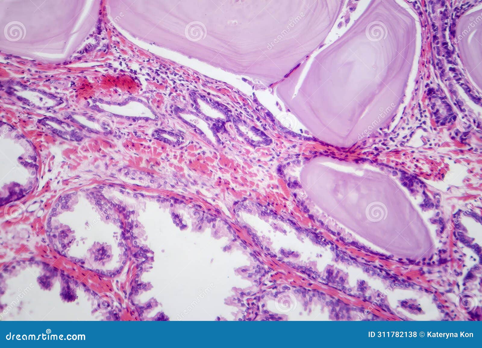 Benign Prostatic Hyperplasia, Light Micrograph Stock Photo - Image of ...