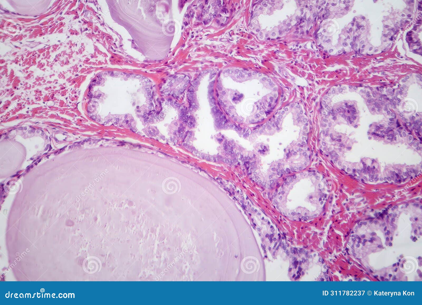 Benign Prostatic Hyperplasia, Light Micrograph Stock Image ...