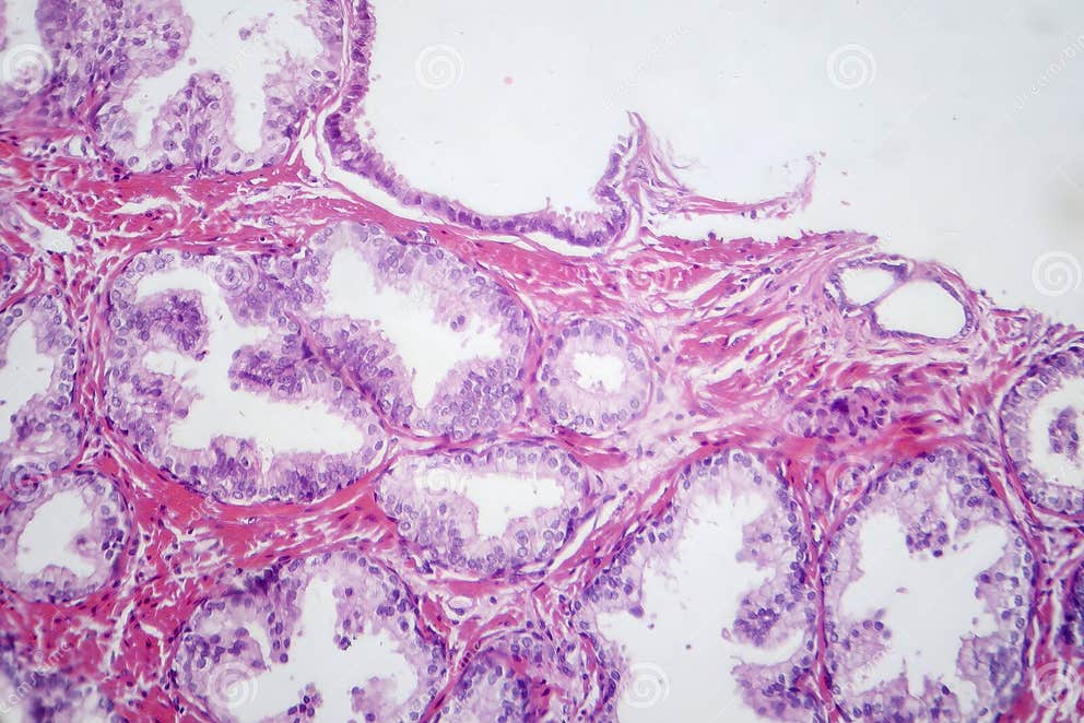 Benign Prostatic Hyperplasia Light Micrograph Stock Image Image Of