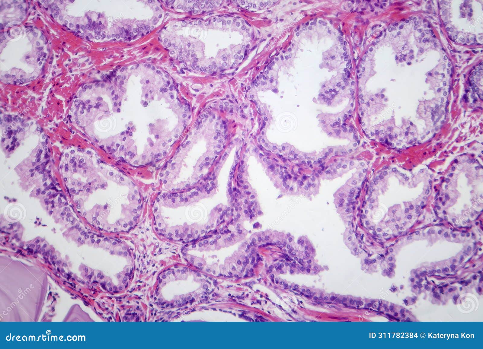 Benign Prostatic Hyperplasia, Light Micrograph Stock Photo - Image of ...