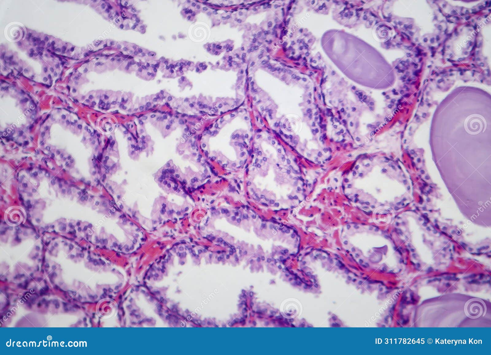 Benign Prostatic Hyperplasia, Light Micrograph Stock Image ...