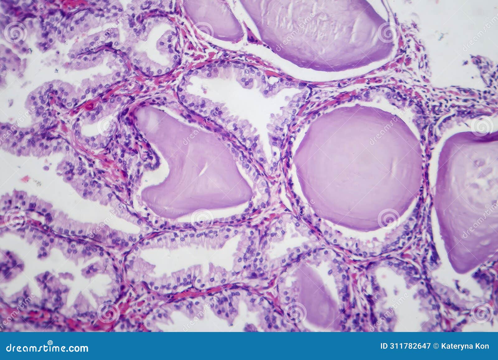 Benign Prostatic Hyperplasia Light Micrograph Stock Image Image Of